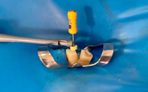 ¿Qué es una endodoncia?, ¿Cuánto cuesta?, ¿Cómo se hace?
